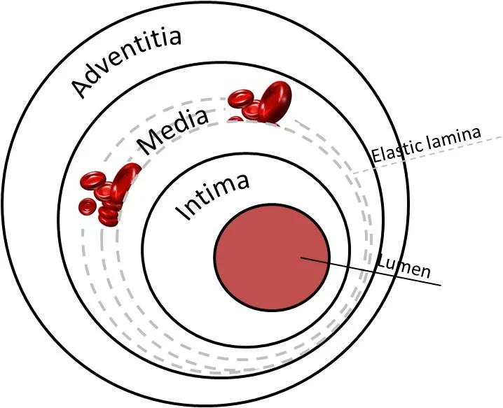 Artery dissection: Causes, Diagnosis and Treatment