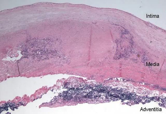 Giant cell Arteritis