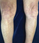 Livedo reticularis and Livedo Racemosa: Diagnosis and Treatment