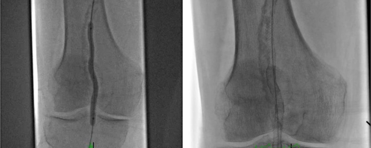Popliteal artery stenting - Vascular Medicine - Angiologist