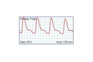 Normal-PVR-waveform1 - Angiologist