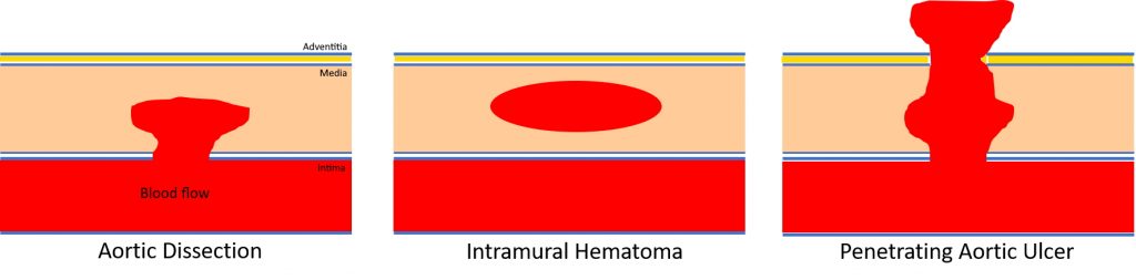 Penetrating Aortic Ulcer: Diagnosis and Management