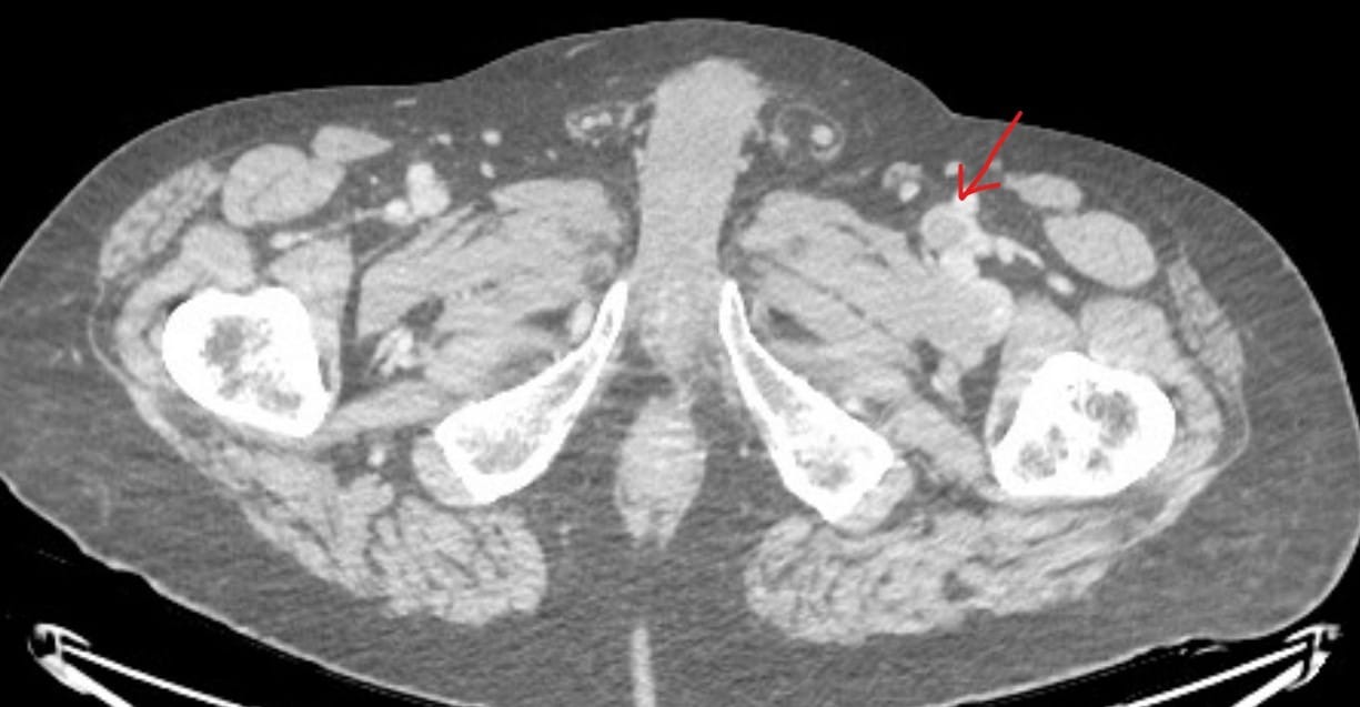 DVT on CT - Angiologist