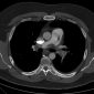 Subsegmental pulmonary embolism: Prognosis and Treatment