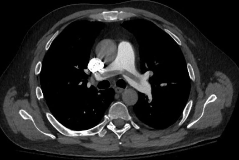 Subsegmental pulmonary embolism: Prognosis and Treatment