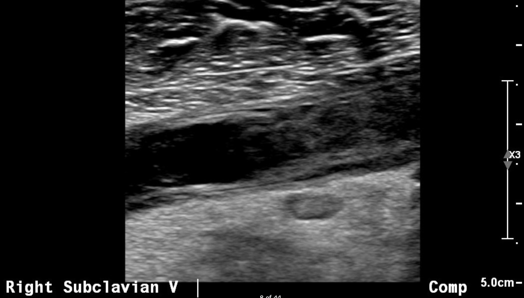 Subclavian-vein-thrombosis - Vascular Medicine - Angiologist