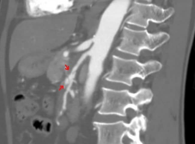 Mesenteric Artery Dissection: Symptoms, Caues, Diagnosis and Treatment